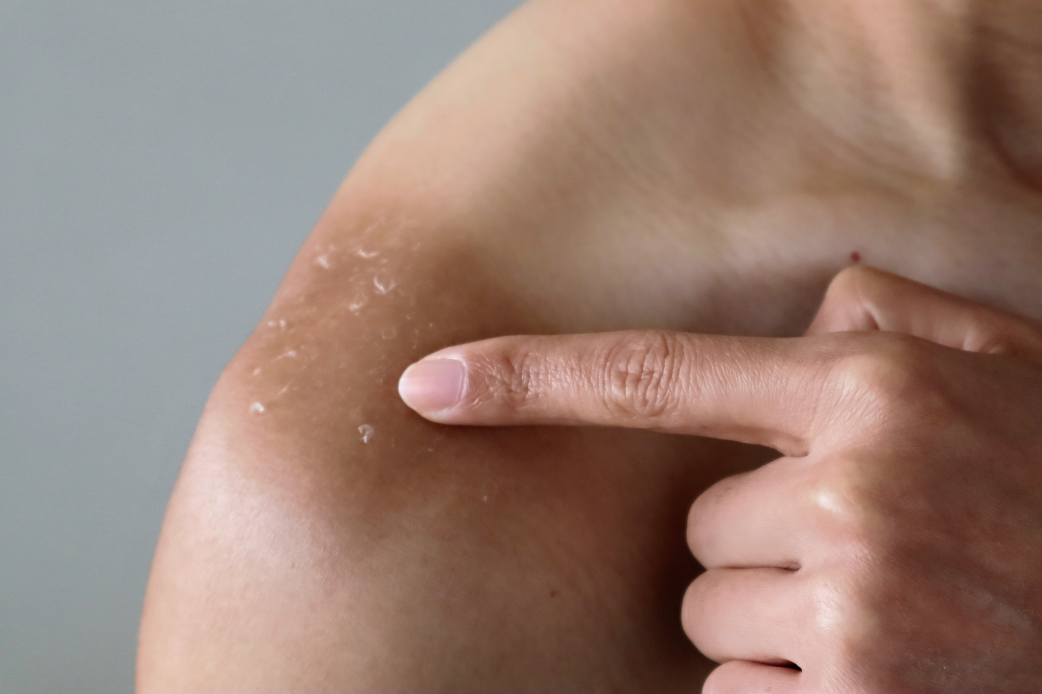 Citius Inks Cardinal Health Deal to Support U.S. Launch of CTCL Therapy ...