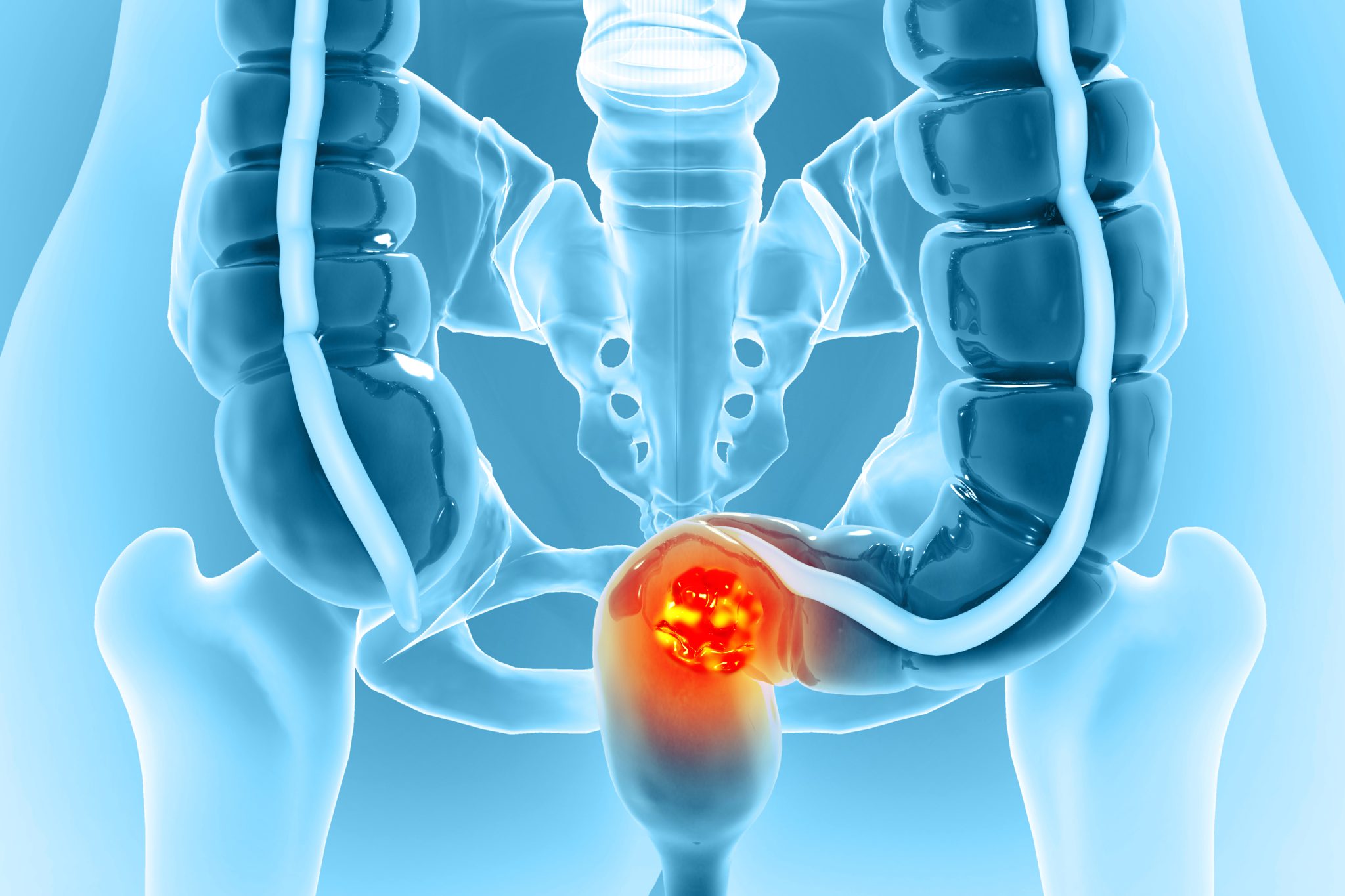 Exelixis Surges Premarket on Strong Survival Data in Phase 3 Colorectal ...