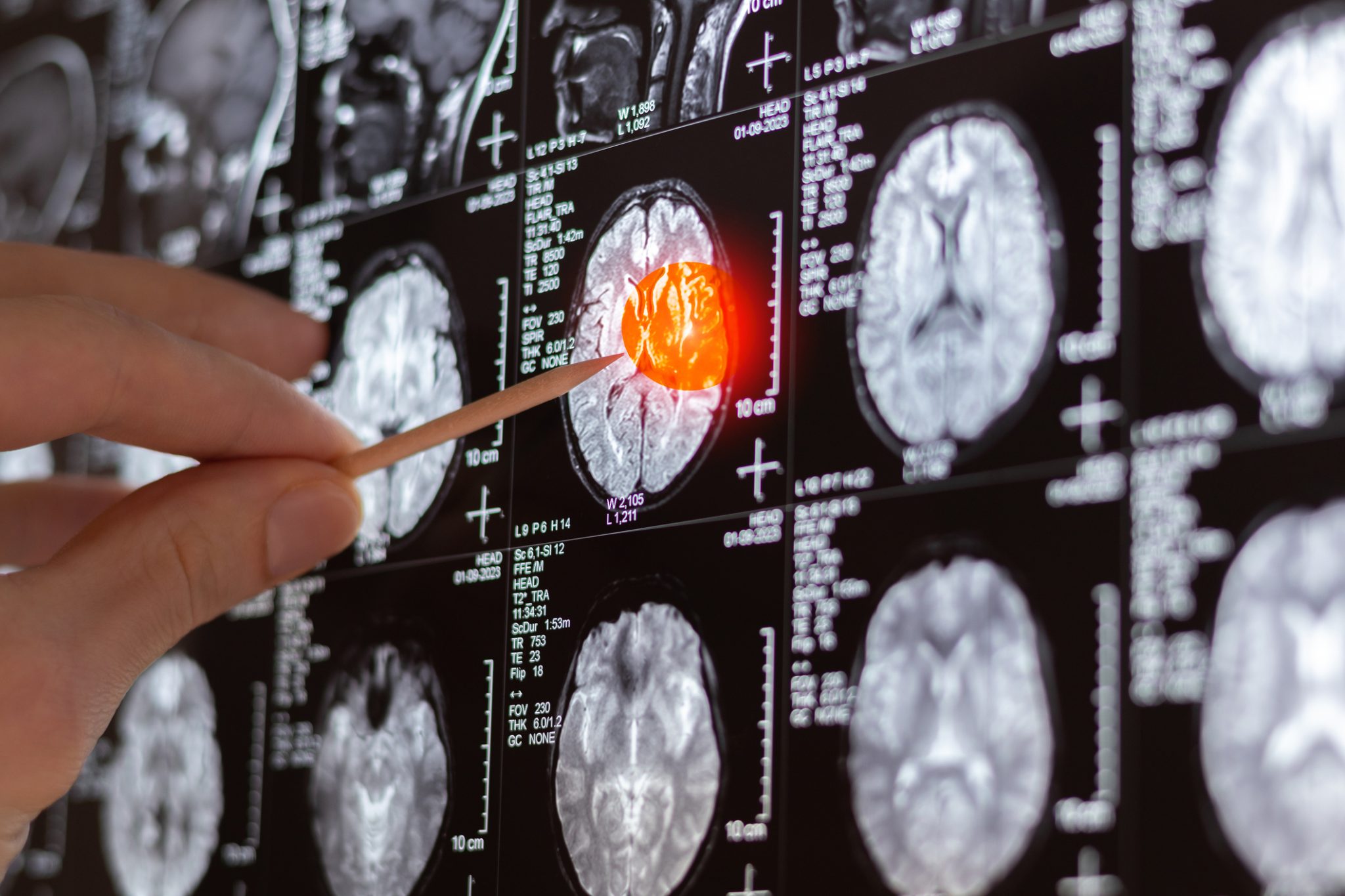 Mustang Bio Gains FDA Orphan Drug Designation for Experimental Brain ...