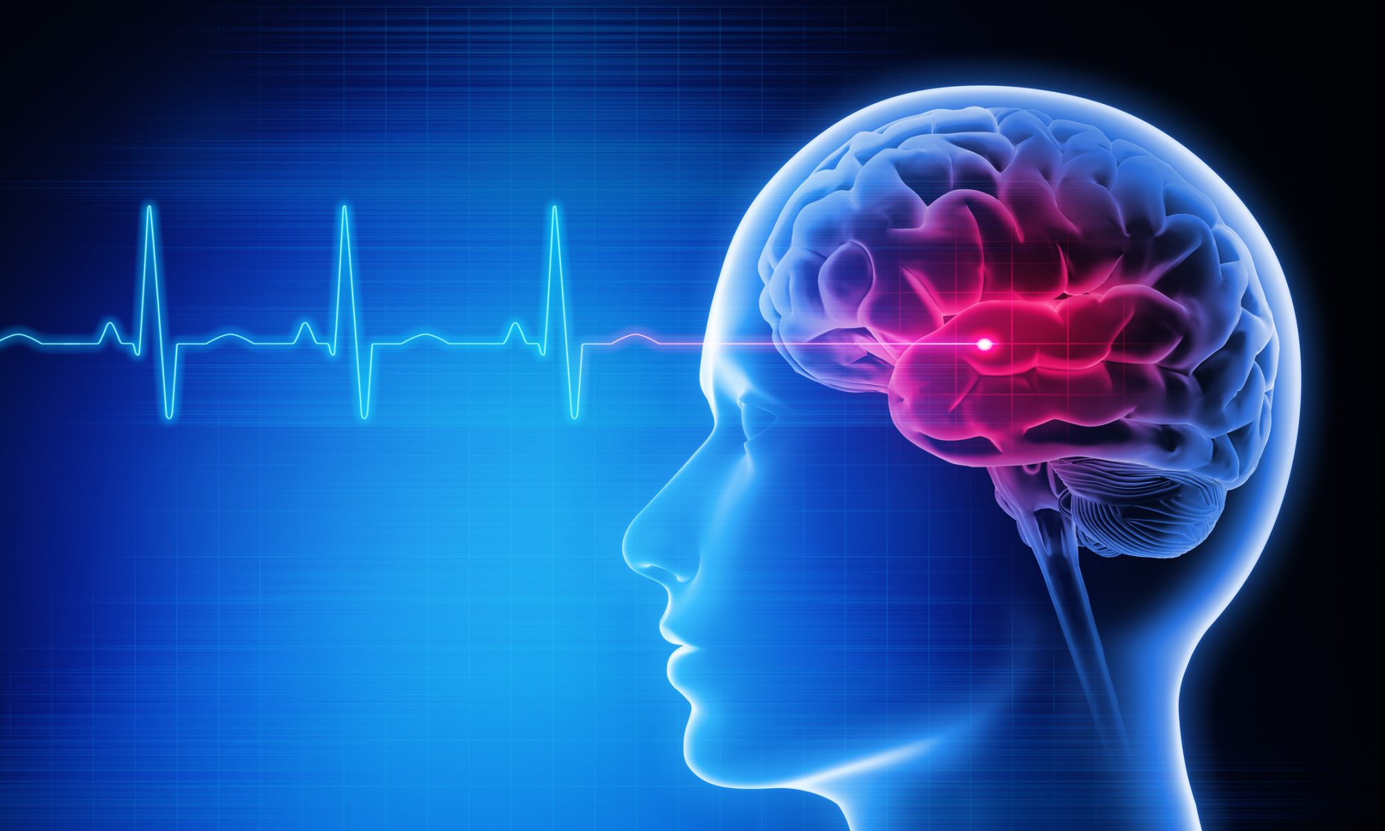 Helius Reports Positive Results for PoNS® Stroke Program, Plans FDA ...