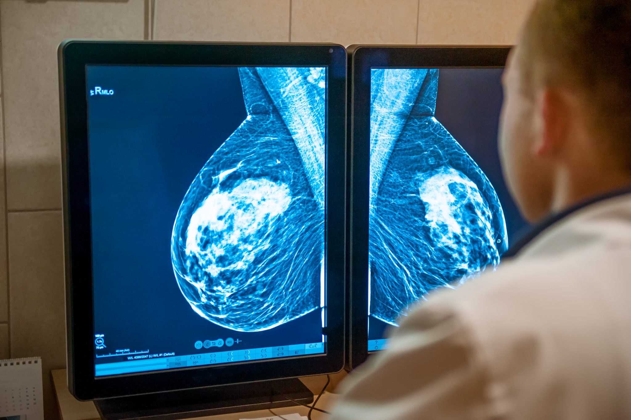 Roche Trial Success Puts Spotlight Back on Olema’s Breast Cancer ...