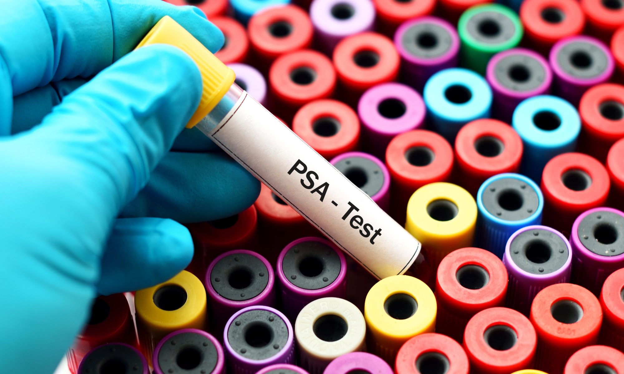 Trinity Biotech Advances Prostate Cancer Test with New Collaboration ...