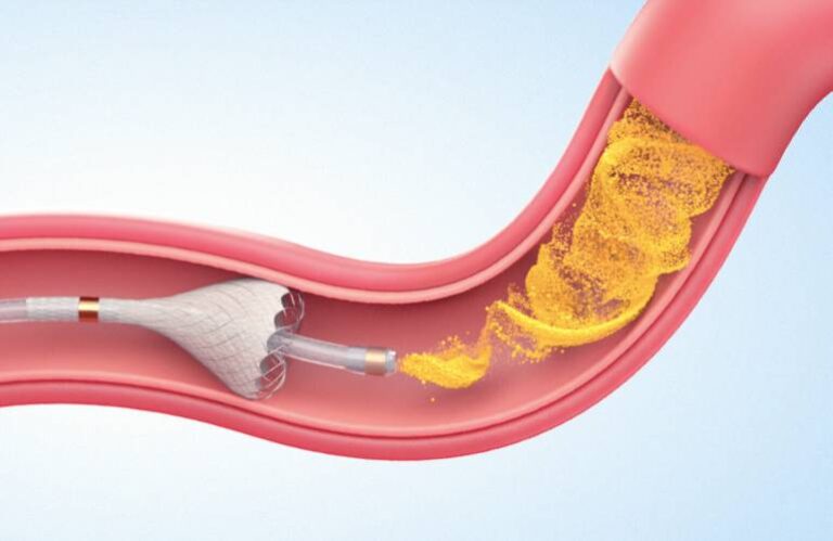 TriSalus Life Sciences Debuts TriNav® XP, Expanding Its Pressure ...