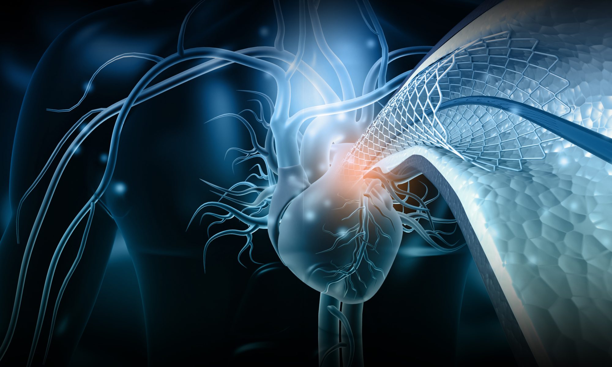 Transmural Systems Secures FDA Clearance for TELLTALE Guidewire ...