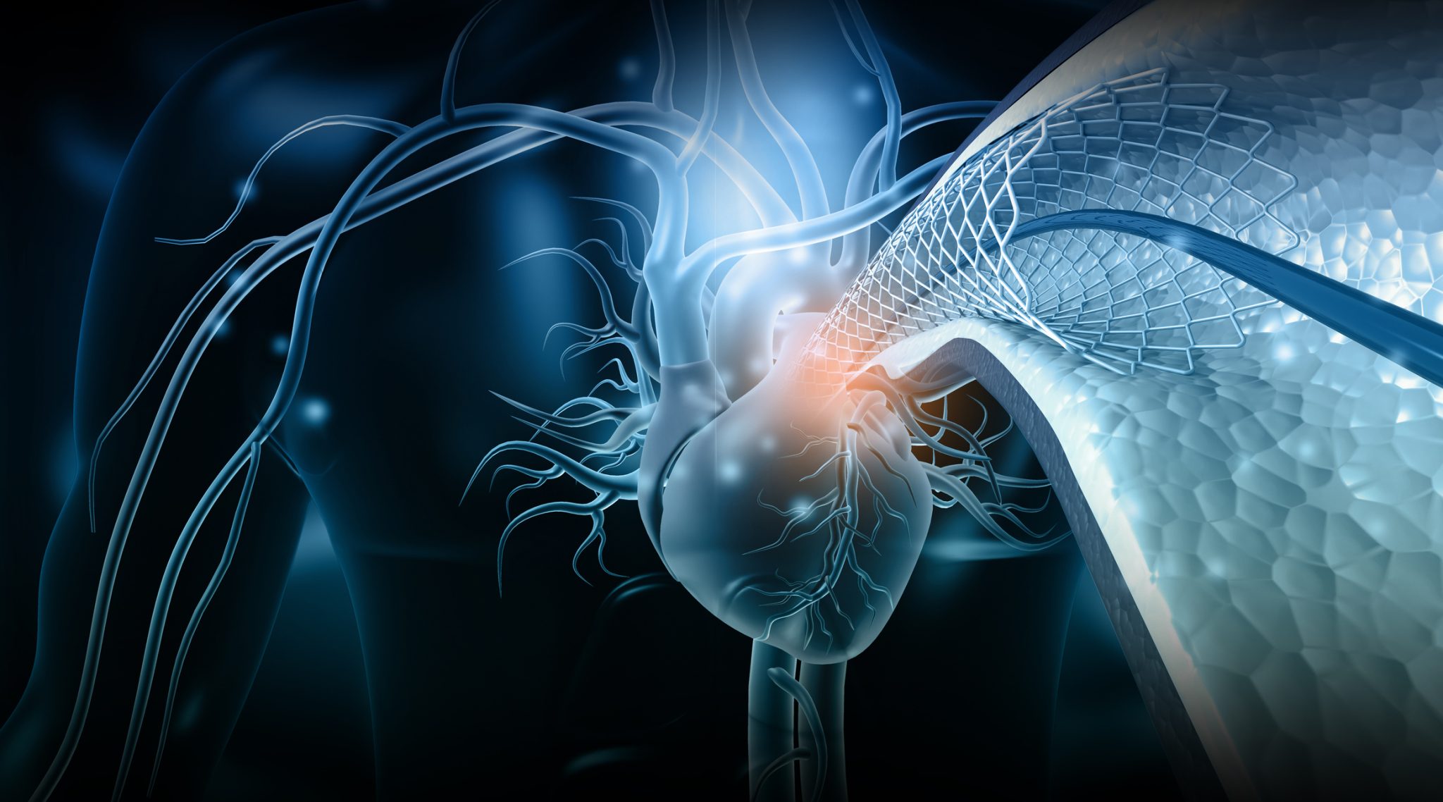 Transmural Systems Secures FDA Clearance for TELLTALE Guidewire ...