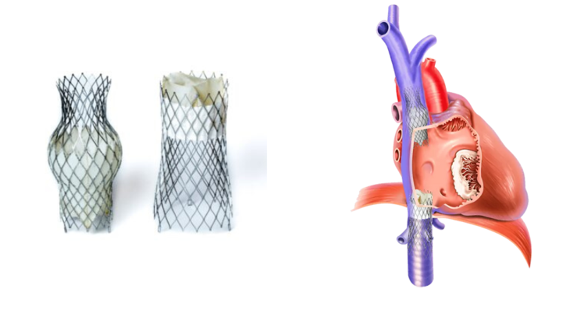 FDA Clears TRICAV II Pivotal Trial for TricValve System - PRISM MarketView