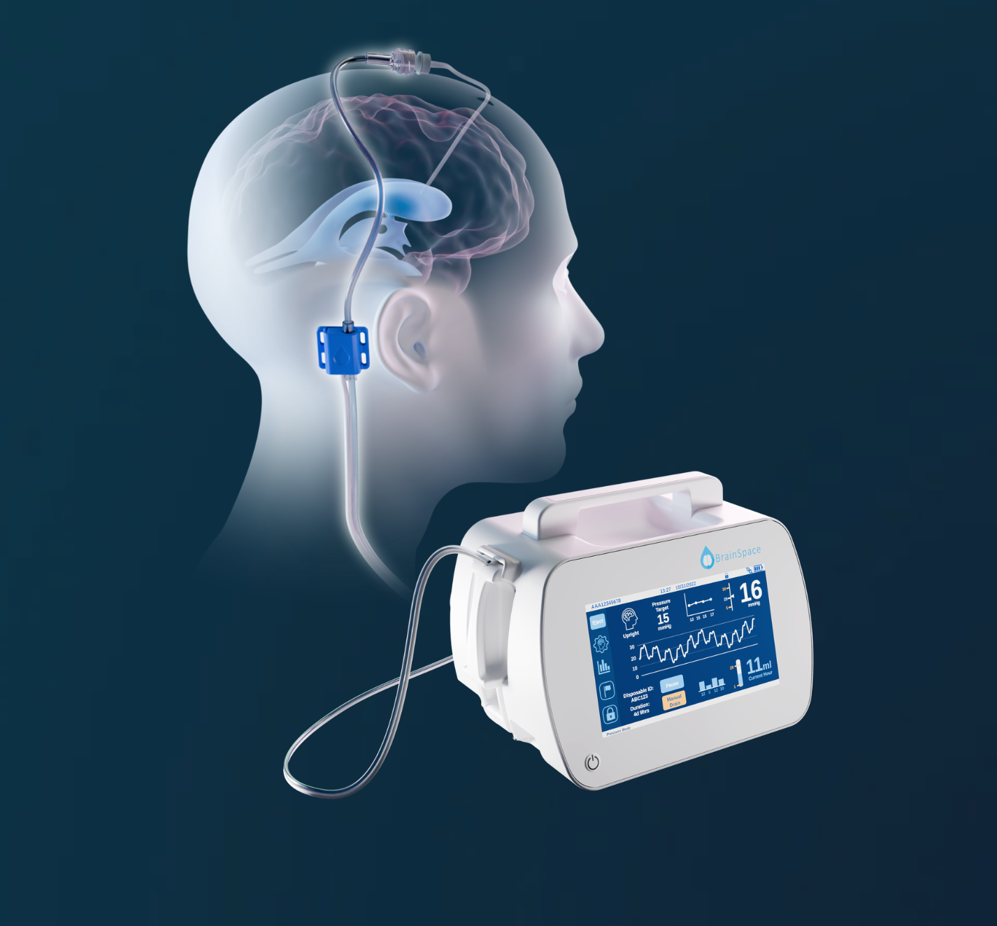 FDA Clears BrainSpaces’ Automated Brain Fluid Management System for ...